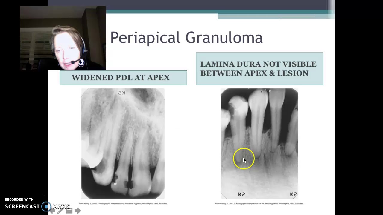 Periapical Radiolucency & Radiopacity