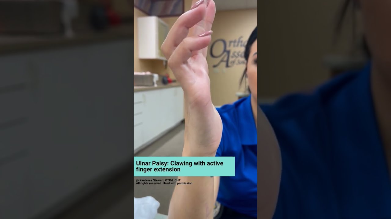 Example of ulnar palsy patient with a claw deformity with PIP joint contracture