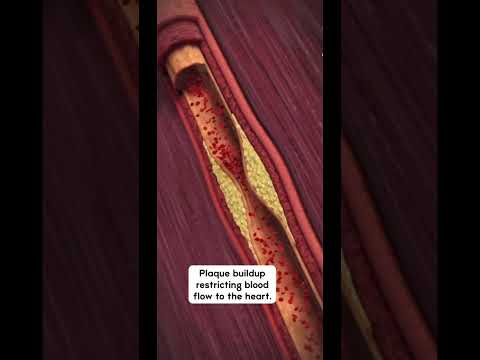 Coronary Artery Stent Medical Procedure