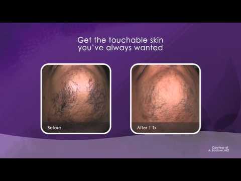 Cynosure Hair Removal