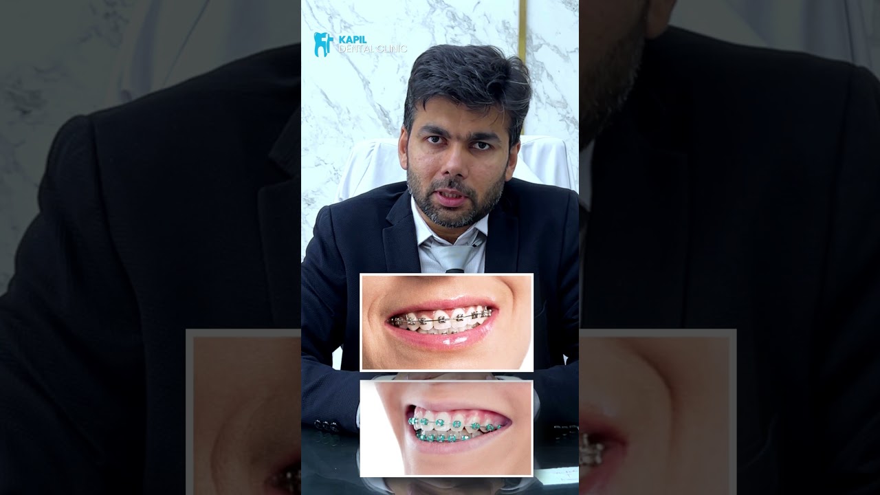 Braces Cost in India 2025 😱 | डेंटल ब्रेसेस (दांतों के ब्रेसेस) की कीमत | Dr. Kapil Saroha