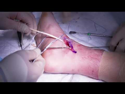 Deltoid Ligament Reconstruction - Citrefix Suture Anchors & Citrelock Tendon Fixation Device System