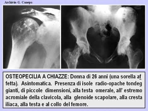 Z25 osteopecilia 94 101