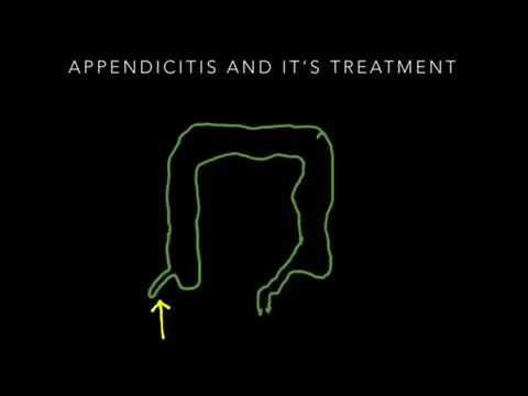 What is Appendicitis? What is it's treatment Appendectomy