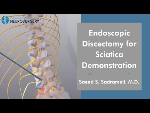 Endoscopic Discectomy for Sciatica Demonstration | Saeed S. Sadrameli, M.D.