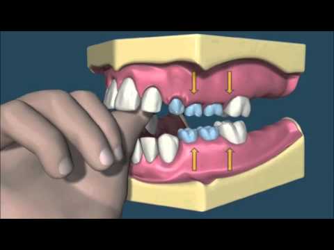 Consecuencias de la succión digital | todologopedia