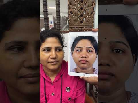 Rhinoplasty Before & After