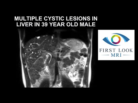 MULTIPLE CYSTIC LESIONS IN LIVER IN 39 YEAR OLD MALE
