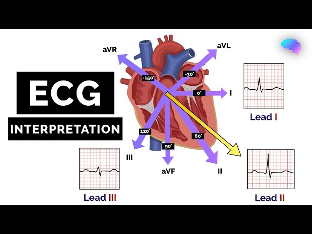 How to Interpret an ECG Using a Structured Approach for Accurate ...