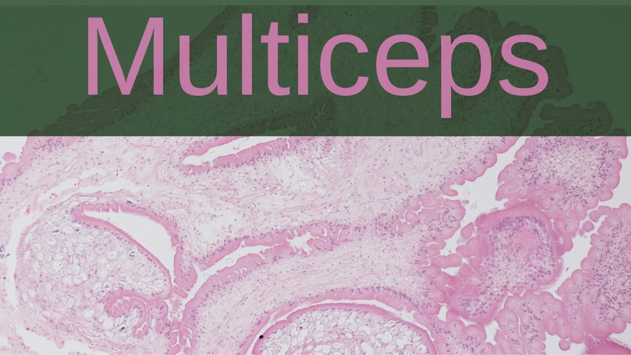 Taenia Multiceps - Pathology mini tutorials
