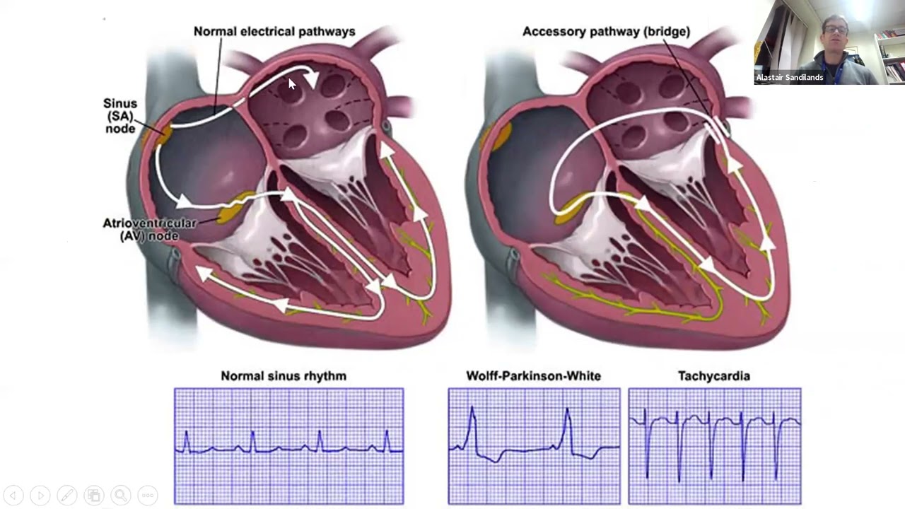 ECG lecture 4 narrow complex tachycardias