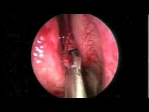 Ethmoidectomy In The Office With Local Anesthesia - St. Louis Sinus Center
