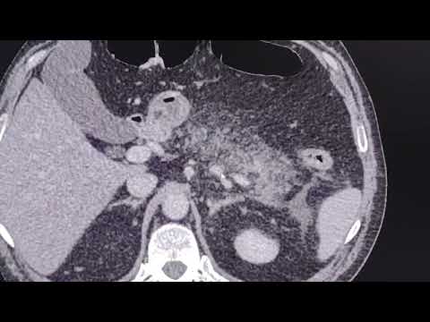 Chronic recurrent pancreatitis - CT findings