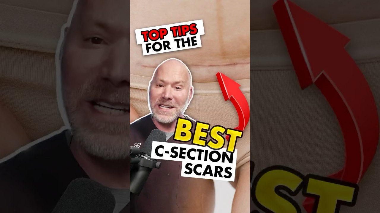 Top C-Section Scar Tips
