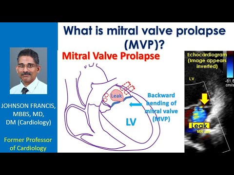 What is mitral valve prolapse (MVP)?