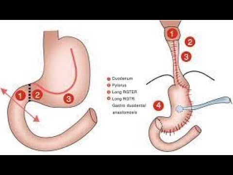 Esophagoplasty CPT code - simplify medical coding