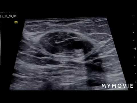 breast hamartoma • ultrasound case