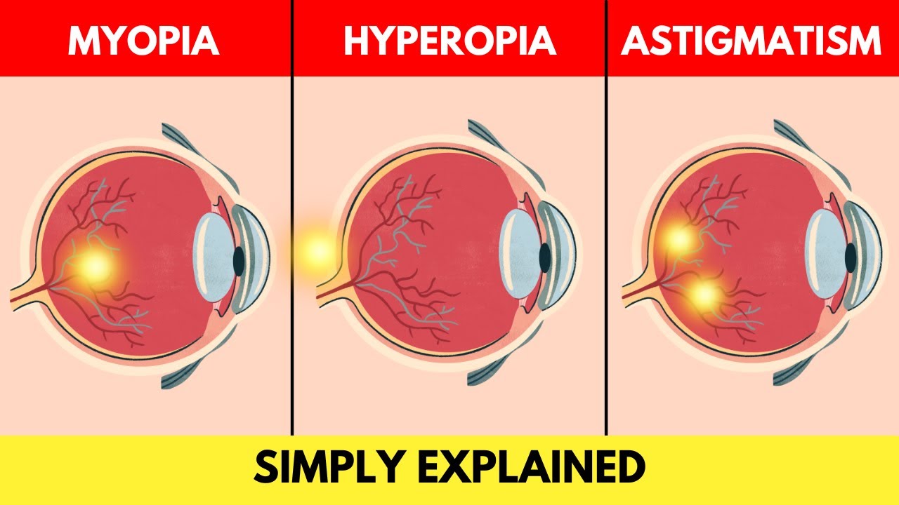 Blurry Near or Far? Understanding Myopia, Hyperopia & Astigmatism