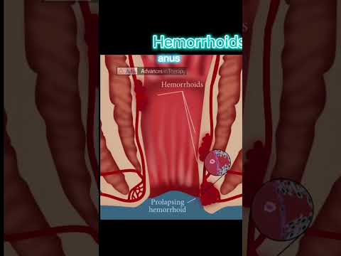 HEMORRHOIDS - MEDICAL DEFINITION | Medical Consecutive Interpreting