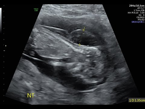 Ultrasound Case Review with Dr. Longman, UChicago Medicine Ob/Gyn: Noonan Syndrome
