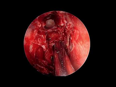 Endoscopic meningocele and CSF rhinorrhea repair