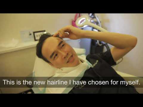 FUE Hair Transplant - No Down time - Dr Chow Personal Journey