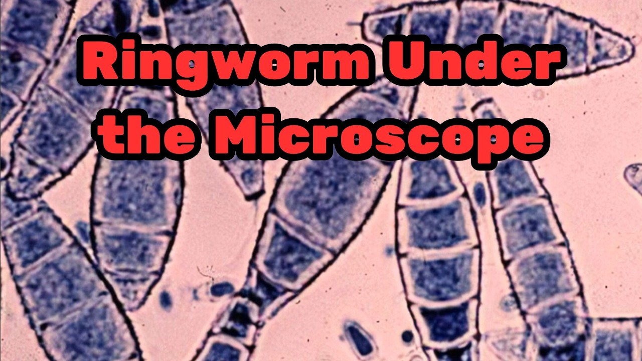 Dermatophytes – A Microscopic Journey into Ringworm