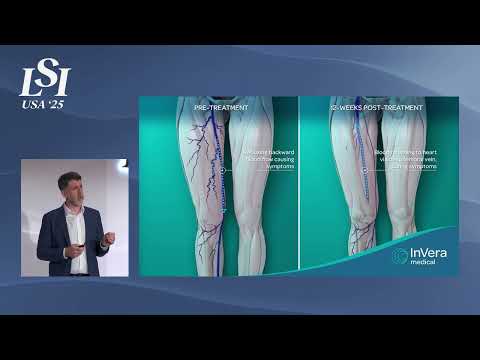 Stephen Cox, InVera Medical - Non-Thermal Catheter Therapy for Venous Disease | LSI USA '25