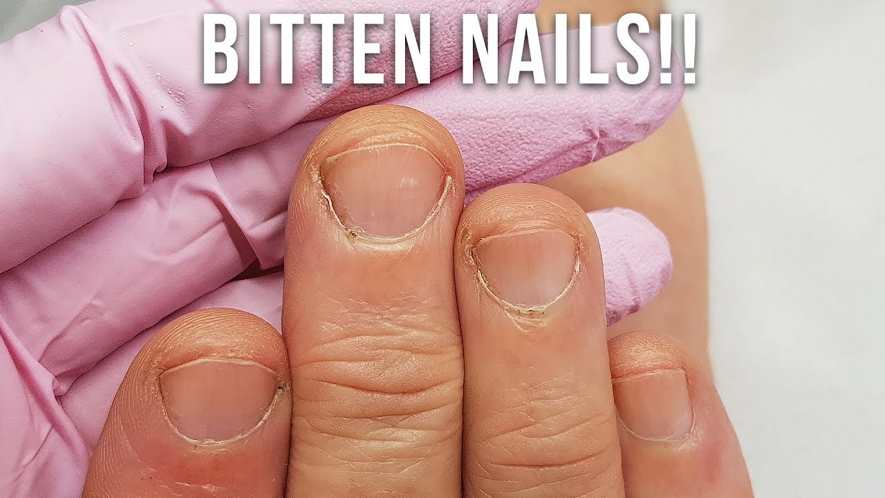 BITTEN NAILS GET ACRYLICS