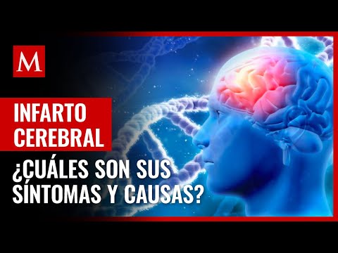 ¿Hay síntomas? ¿Qué es un infarto cerebral y cuáles son sus posibles causas?