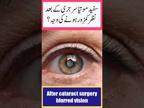 Safed Motia | After cataract surgery blurred vision in Hindi/Urdu