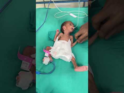 #pretermbaby #lowbirthweight #orogastrictube feeding#baby #hospital #pediatrics #icu #ward #infants