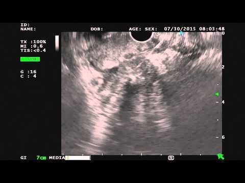 Diagnosis of Diffusely Infiltrative Pancreatic Cancer by EUS-FNA - Bronte Holt