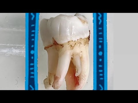 SUPERNUMERARY ROOTS: DISCOVERING DENTAL ANOMALIES 🦷🧬🌍