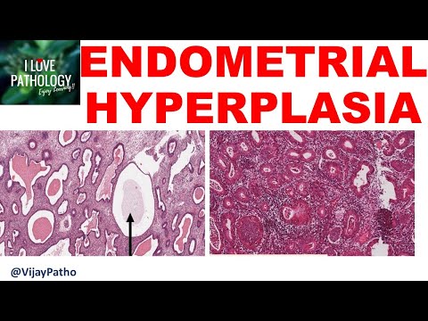 ENDOMETRIAL HYPERPLASIA : Etiopathogenesis, classification Diagnosis & treatment