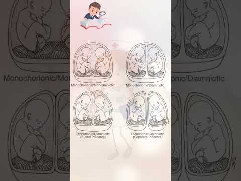 Types of Twin pregnancy #nursingnotes #nursing #shorts #twins