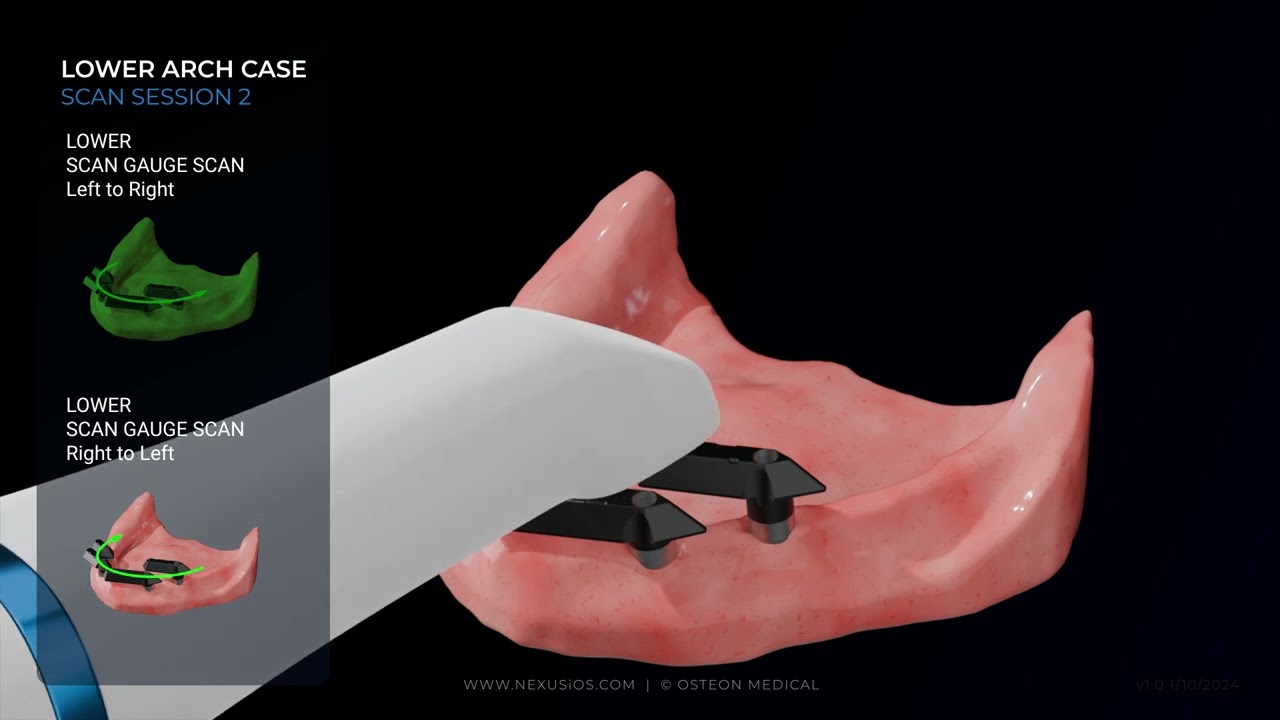 Nexus iOS - Definitive Protocol Screw Retained - Lower Arch
