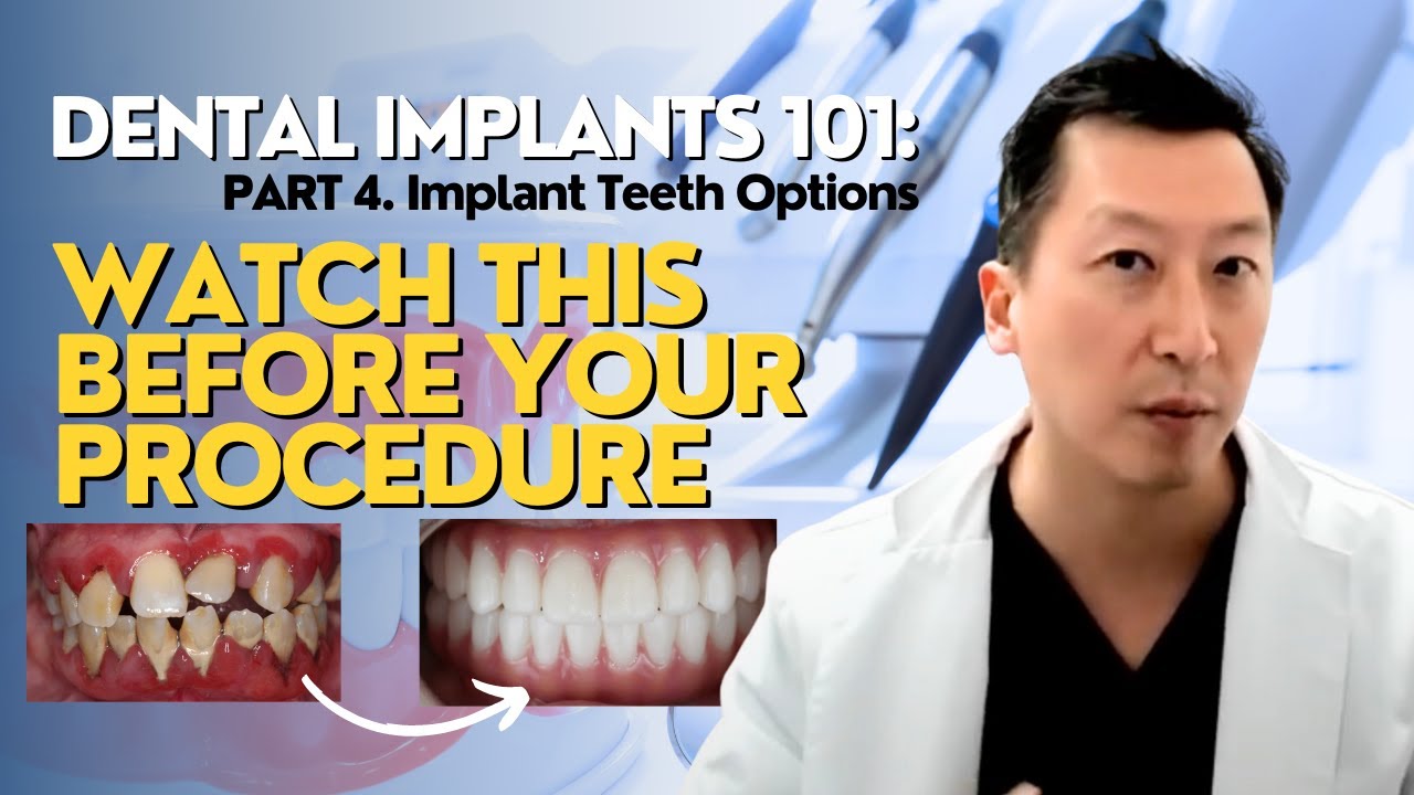 Dental Implants 101: What You NEED to Know! Part 4 (Implant Teeth Options)