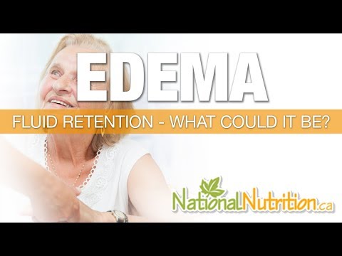 Edema: Causes, Treatment, and Management | National Nutrition Article ...