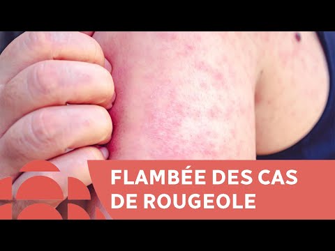 Rougeole : analyse de la maladie et l'importance de la vaccination