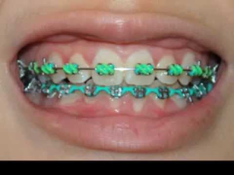 Brackets de colores neon - Imagui