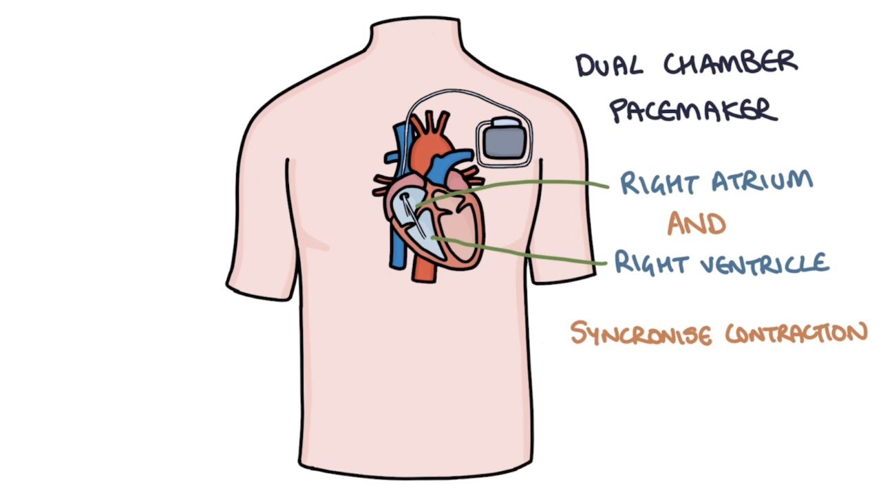 Understanding Pacemakers