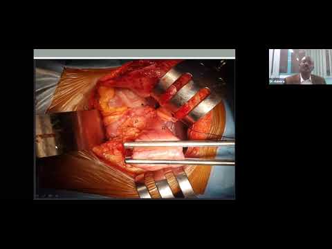 200 consecutive pancreaticoduodenectomies- 4 years experience Dabora