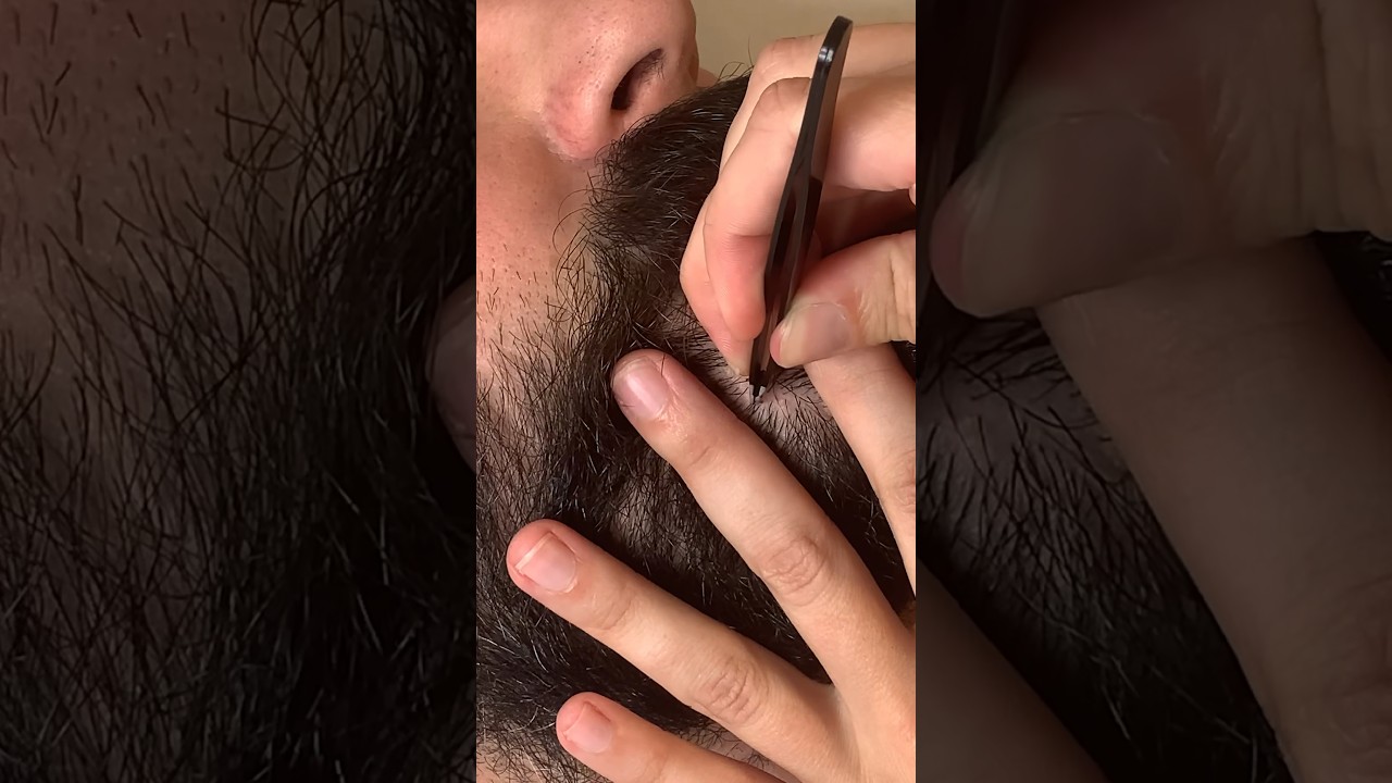 THE BEST beard hair removal! #ingrown #follicle #beardhair #hairremoval