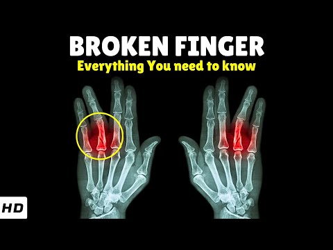 Broken Finger? Here's Everything You Need to Know to Heal Fast!