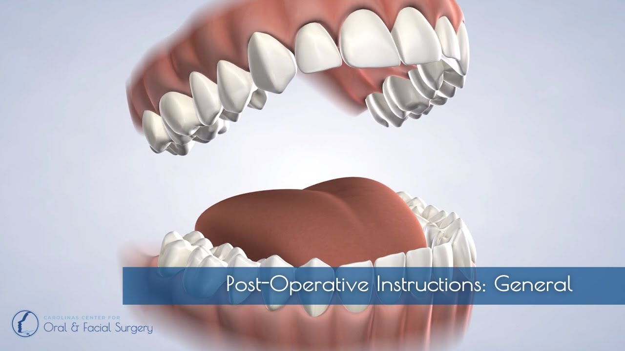 Post-Operative Instructions: General