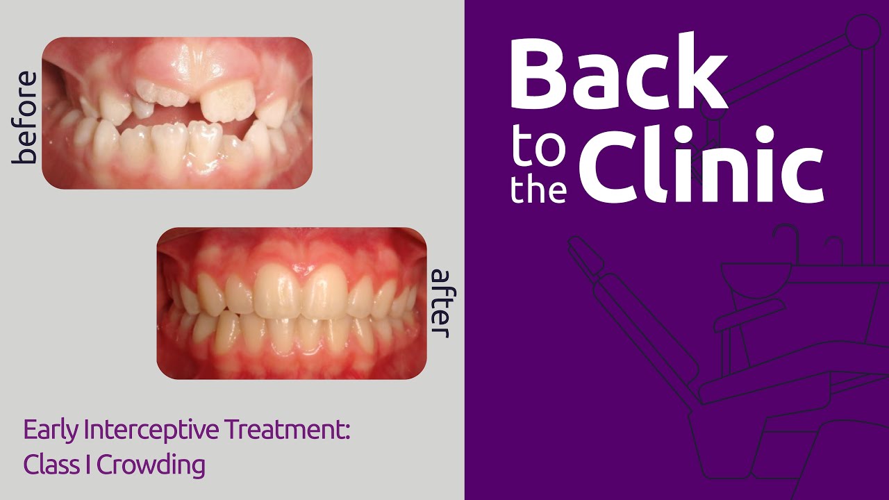 Early Interceptive Treatment: Class I Crowding  - Back to the Clinic #009