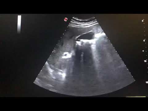 Litiasis vesicular en ecografía.Gallstone in ultrasound. – Ecografia En ...