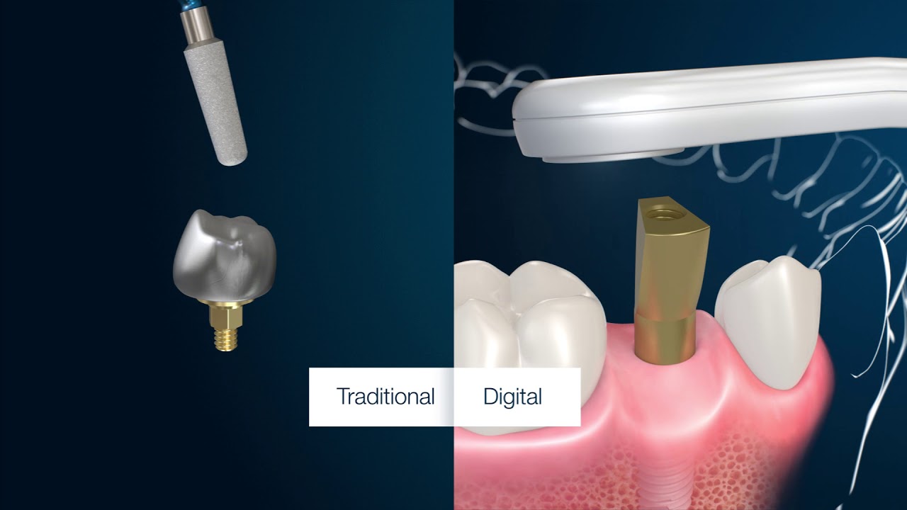 MIS CONNECT - Versatile One-Time Solution