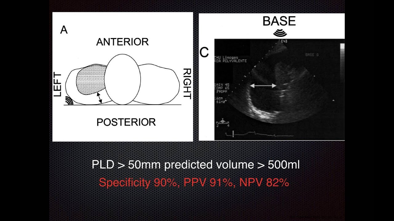 Estimate Pleural Effusion Volume